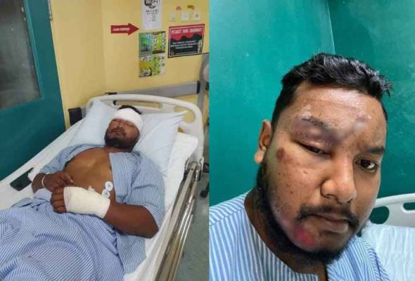 CEO Batu terlibat kemalangan, terima lebih 20 jahitan | Astro Awani